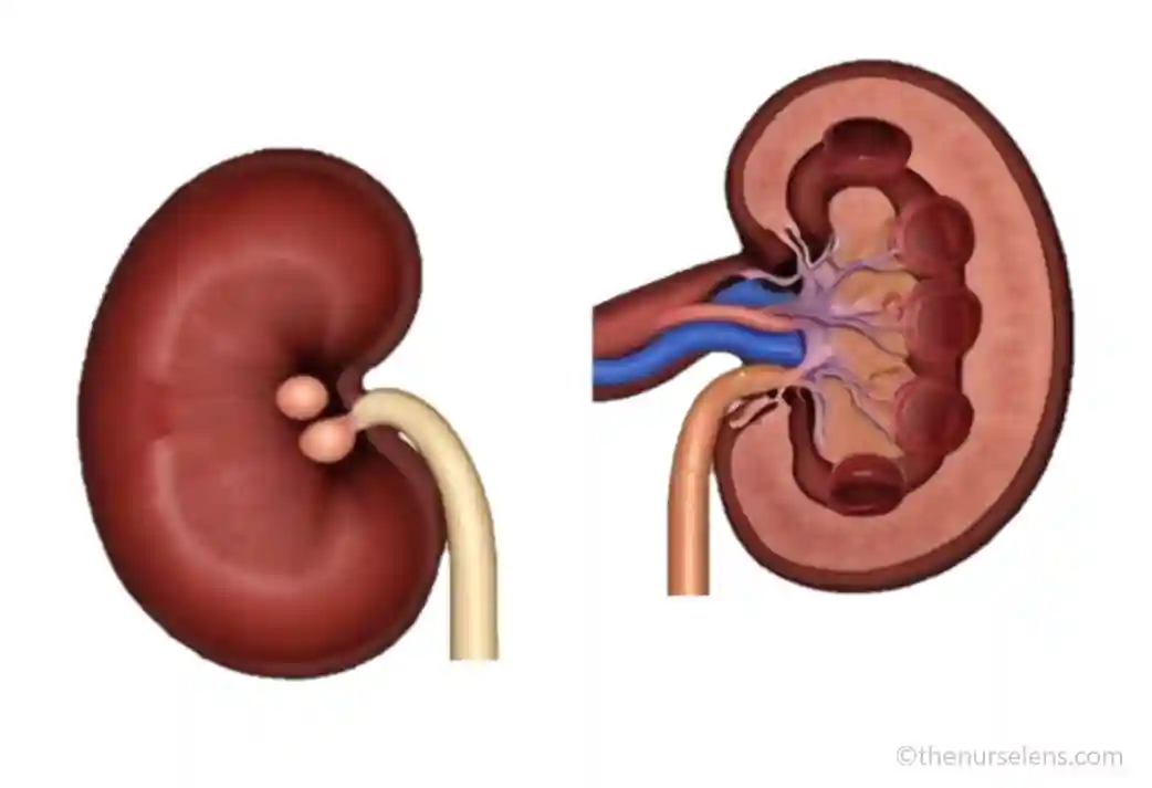 Pyelitis: Causes, Pathophysiology, Symptoms and Treatment